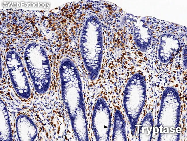 Systemic Mastocytosis : GI - Tryptase Tract