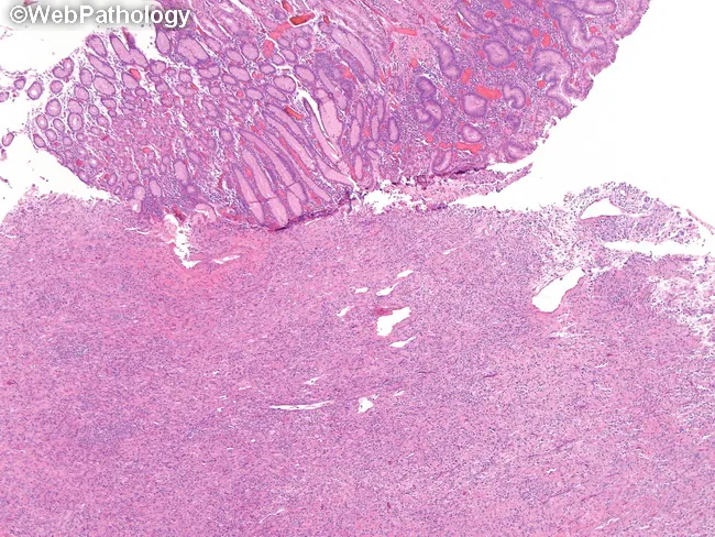 Histiocytic Sarcoma : Introduction