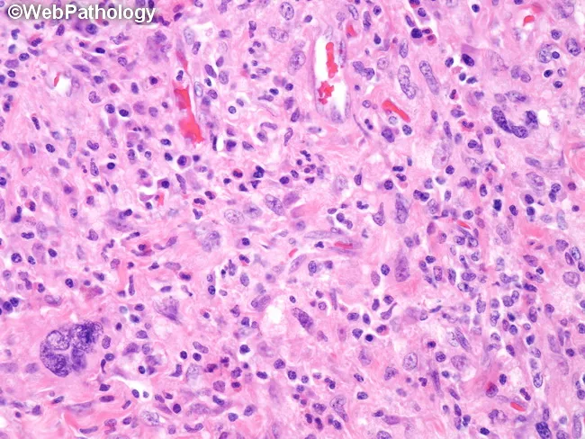Histiocytic Sarcoma : Microscopic