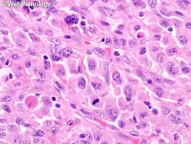 Histiocytic Sarcoma : Microscopic