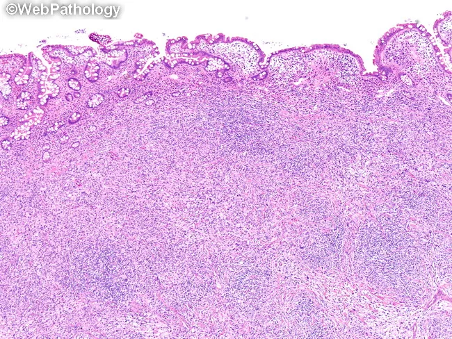 Histiocytic Sarcoma : Differential