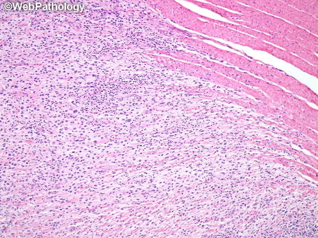 Histiocytic Sarcoma
