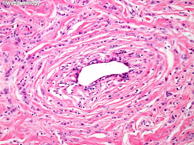 Infiltrating Lobular Carcinoma