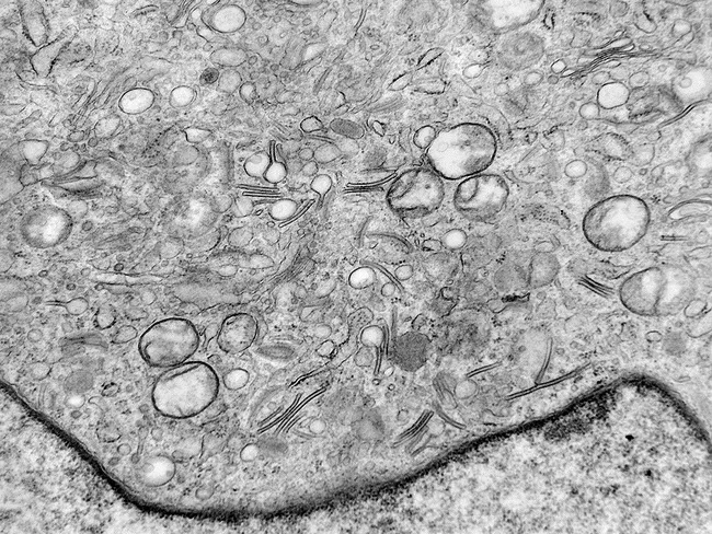 LCH : Birbeck Granules