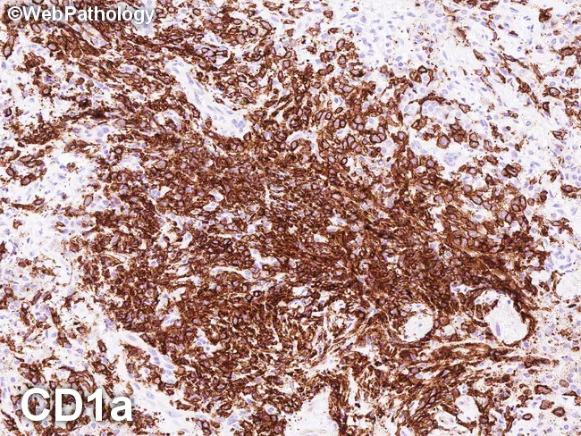 LCH : Immunophenotype