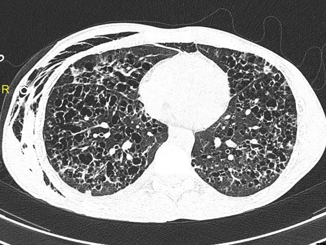 Pulmonary LCH : Imaging