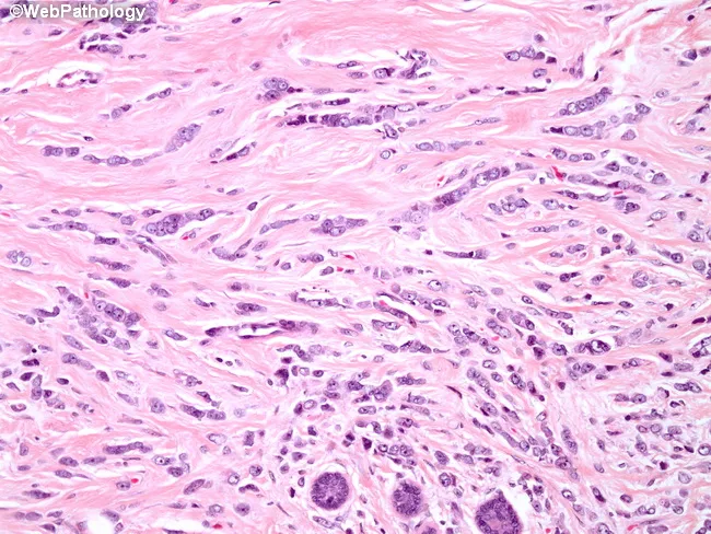 Infiltrating Lobular Carcinoma