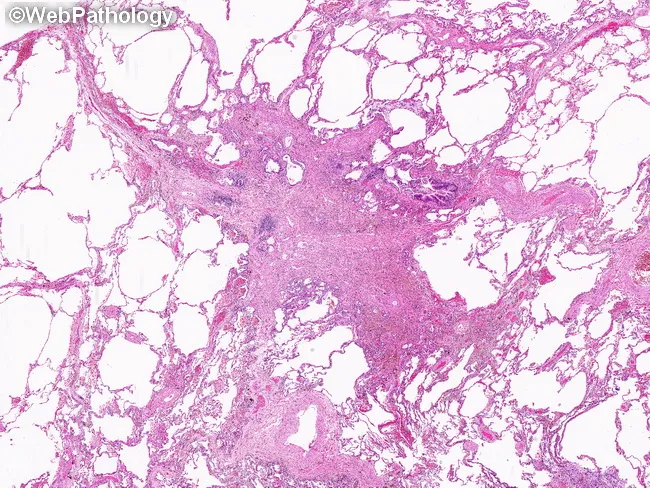 Pulmonary LCH : Morphology