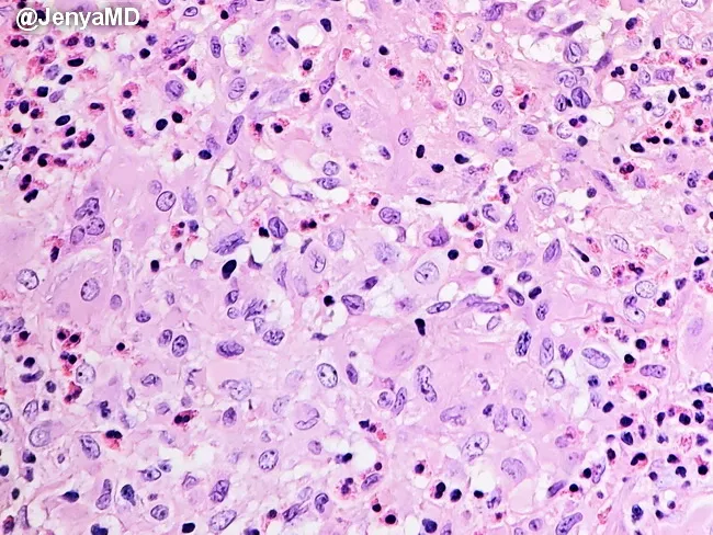 Pulmonary LCH : Morphology