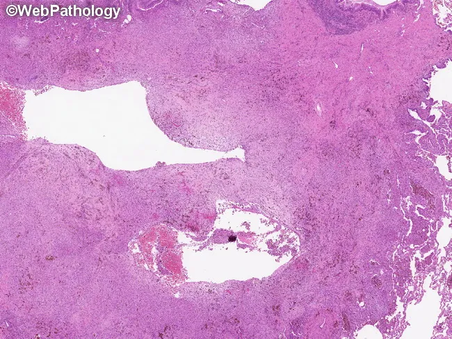 Pulmonary LCH : Morphology