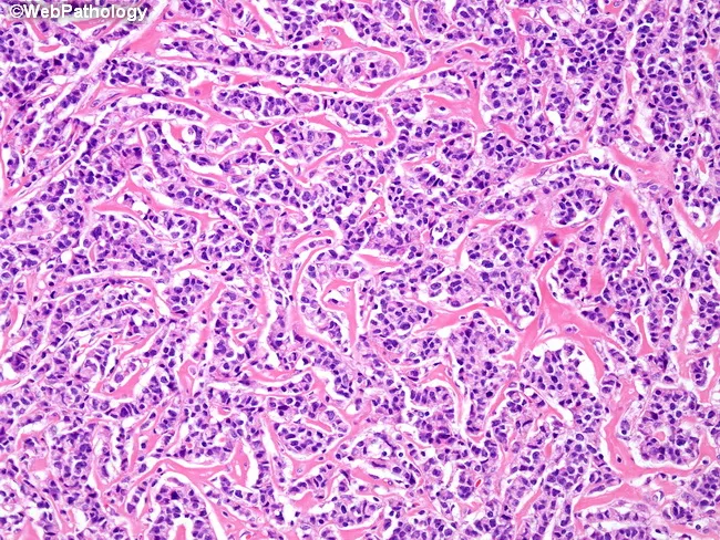 Infiltrating Lobular Carcinoma
