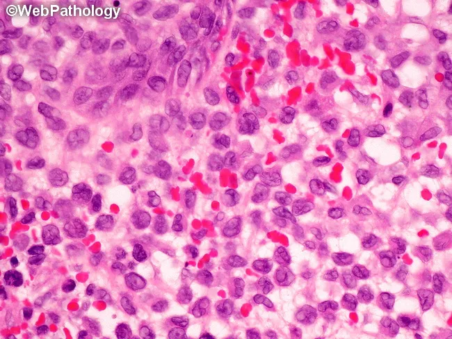 LCH of Skin : Morphology