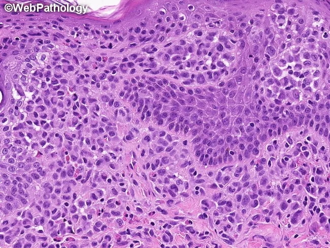 LCH of Skin : Treatment