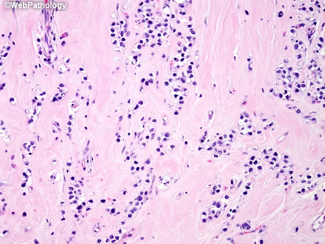 Infiltrating Lobular Carcinoma