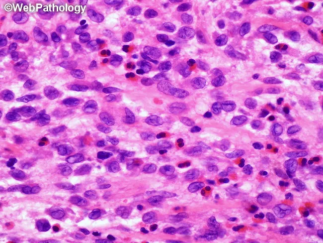 LCH of Bone : Morphology