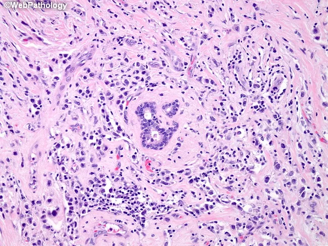 Infiltrating Lobular Carcinoma