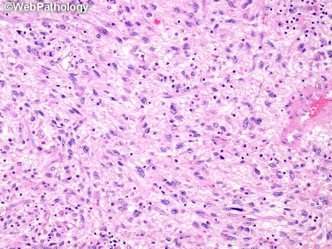 Follicular Dendritic Cell Sarcoma : Gross