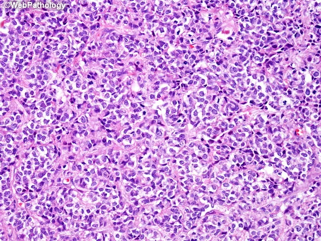 Infiltrating Lobular Carcinoma
