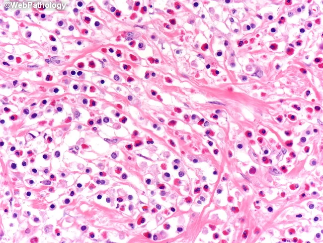 Infiltrating Lobular Carcinoma
