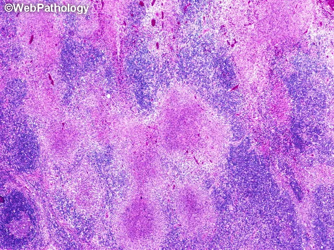 cat scratch disease lymph node