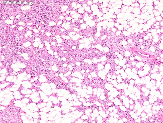 Lobular Carcinoma