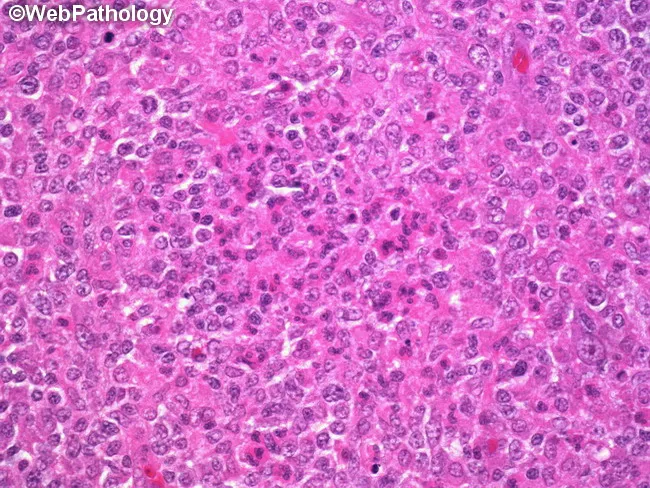 Histologia Do Linfogranuloma Venereo