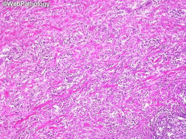 Syphilitic Lymphadenitis
