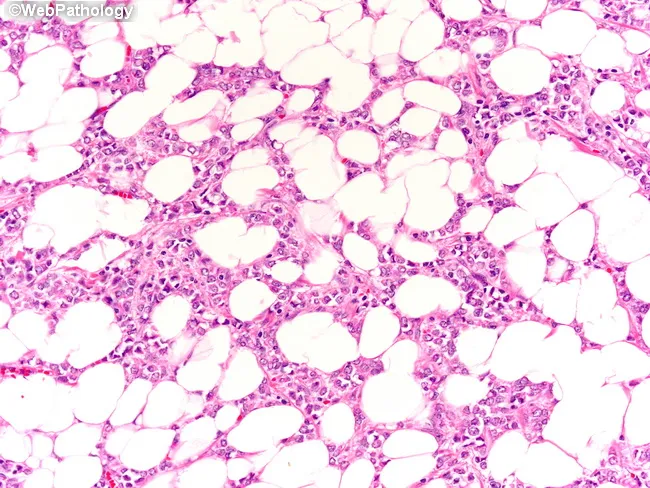 Infiltrating Lobular Carcinoma
