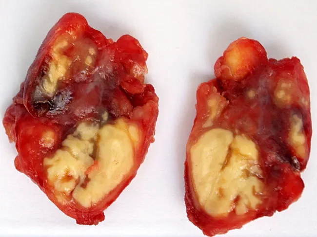 caseous necrosis lymph node