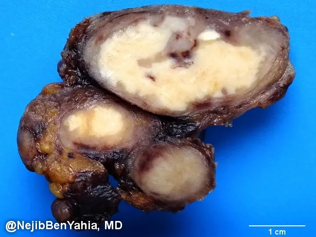 Tuberculous Lymphadenitis: Gross