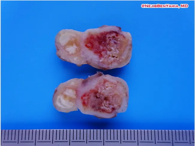Tuberculous Lymphadenitis: Gross