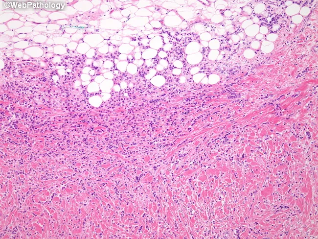 Infiltrating Lobular Carcinoma
