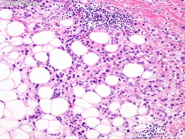 Infiltrating Lobular Carcinoma