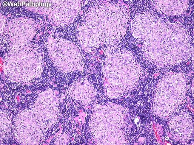 Sarcoidosis Histology Tuberculosis: An Infection Initiated Autoimmune