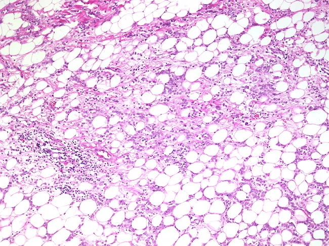 Lobular CA Mimicking Fat Necrosis