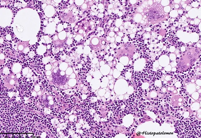 Silicone Lymphadenopathy : Microscopic