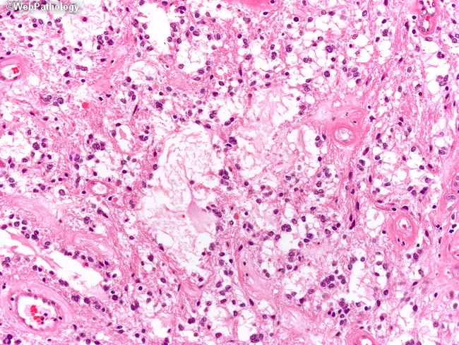 Pilocytic Astrocytoma