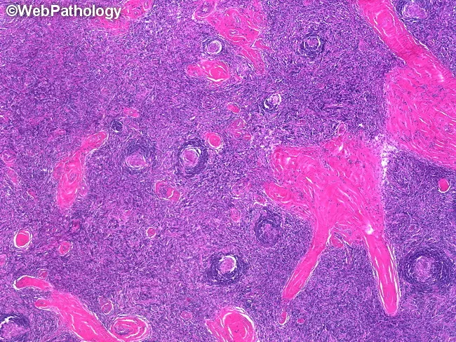 Hyaline-Vascular Castleman Disease : Microscopic