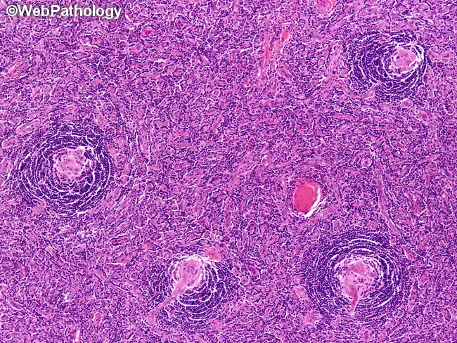 Hyaline-Vascular Castleman Disease : Microscopic