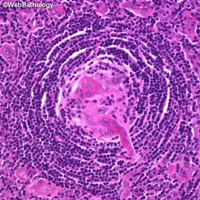 Hyaline-Vascular Castleman Disease : Microscopic
