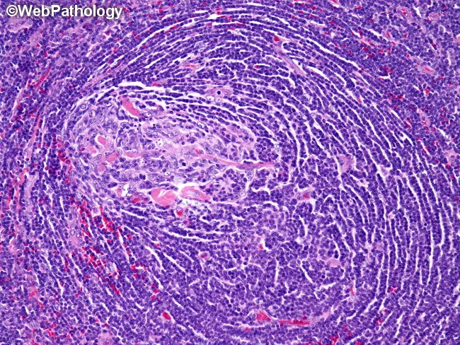 Hyaline-Vascular Castleman Disease