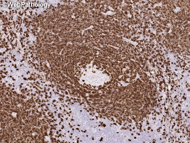 Hyaline-Vascular Castleman Disease : Immunophenotype
