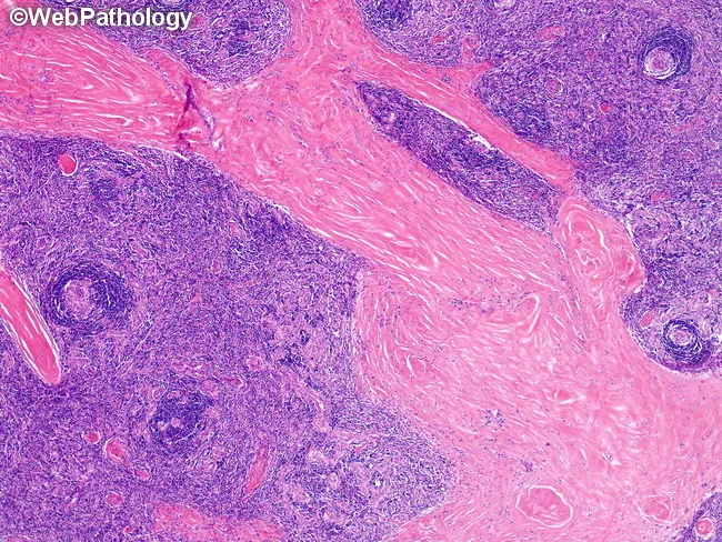 Hyaline-Vascular Castleman Disease : Differential