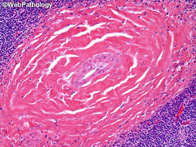 Hyaline-Vascular Castleman Disease : Treatment