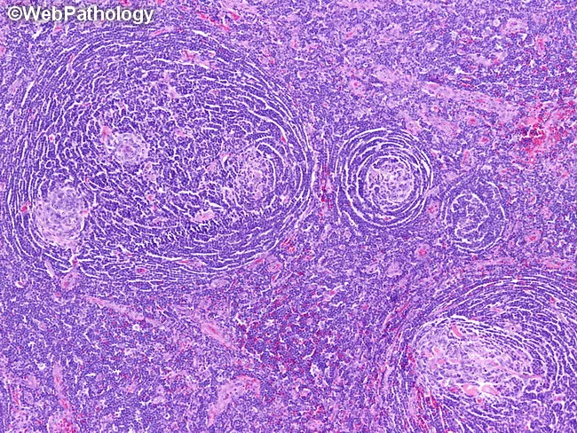 Hyaline-Vascular Castleman Disease : Microscopic