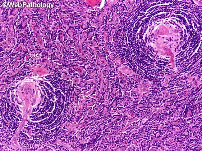 Hyaline-Vascular Castleman Disease