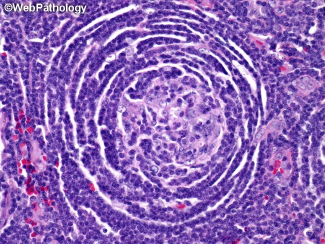Hyaline-Vascular Castleman Disease : Microscopic