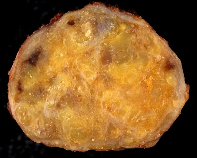Amyloid Lymphadenopathy