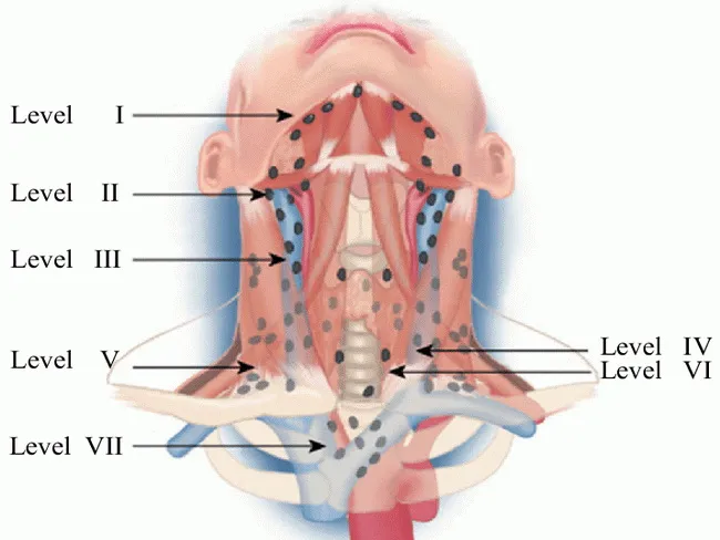 Metastatic Thyroid Cancers : Regional Lymph Nodes