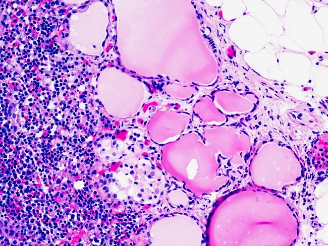 Thyroid Inclusions in Cervical Nodes